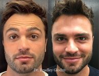 Best Dysport NYC | Botox & Jeauveau New York City