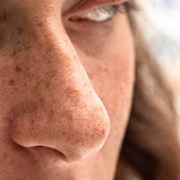 Skin Cancer New York City, Manhattan | Park Avenue Dermatology