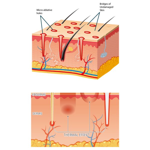 eCO2 Laser New York City, Manhattan | Park Avenue Dermatology