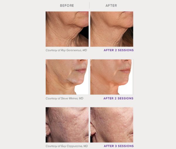 Genius RF Microneedling NYC | Park Avenue Dermatology